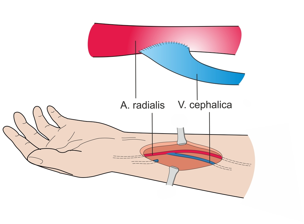 3 Types Of Vascular Access Ports Used In Hemodialysis